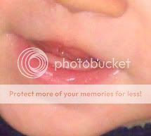 Do these look like pre-teeth bumps to you? PIP — The Bump